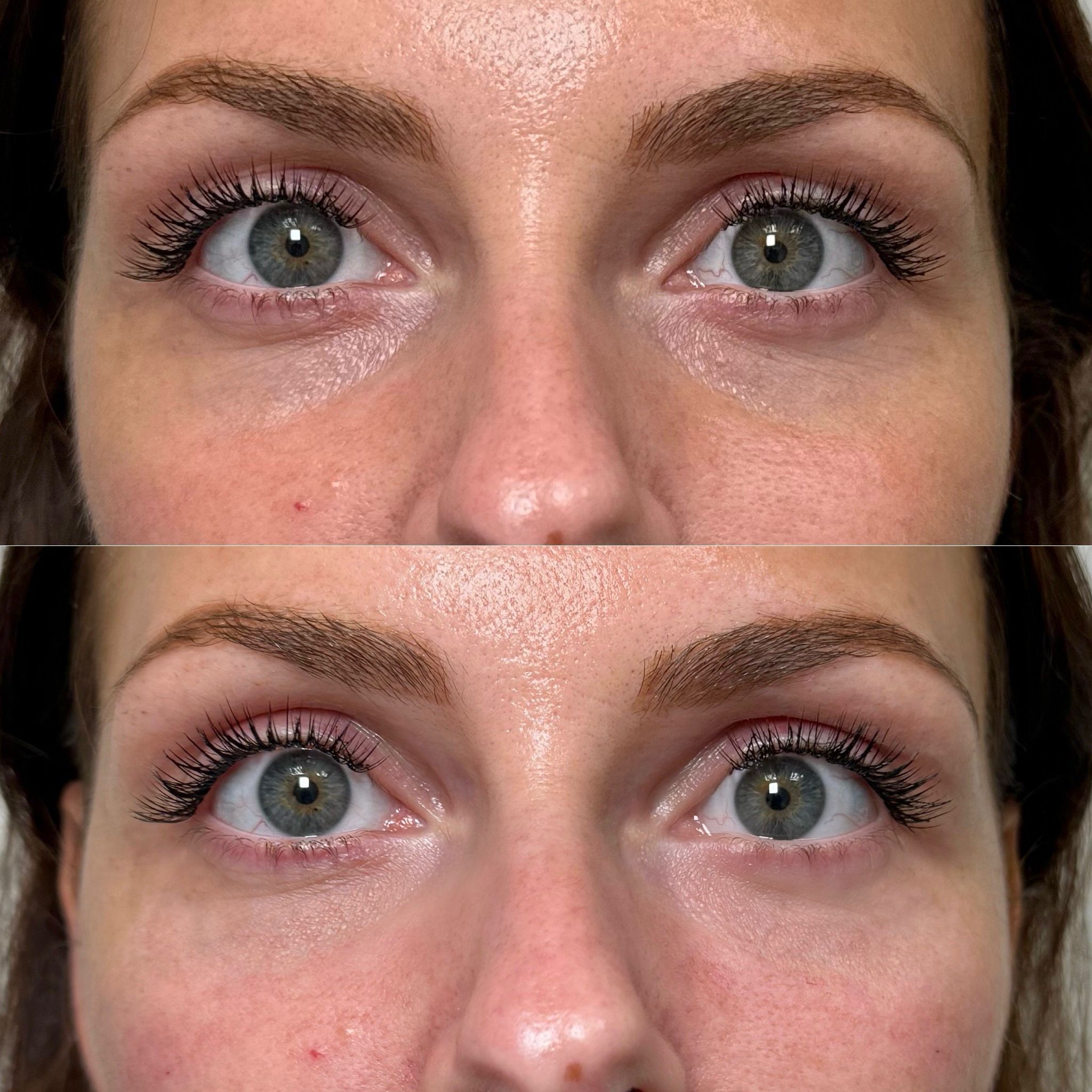 De beste behandeling tegen diepe traangoten - LOOY Clinics